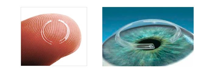 Schedule Keratoconus Treatment | Ophthalmic Associates Southern Tier
